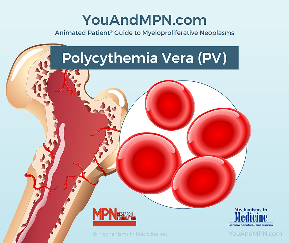 Polycythemia Vera (PV) – MPN Research Foundation