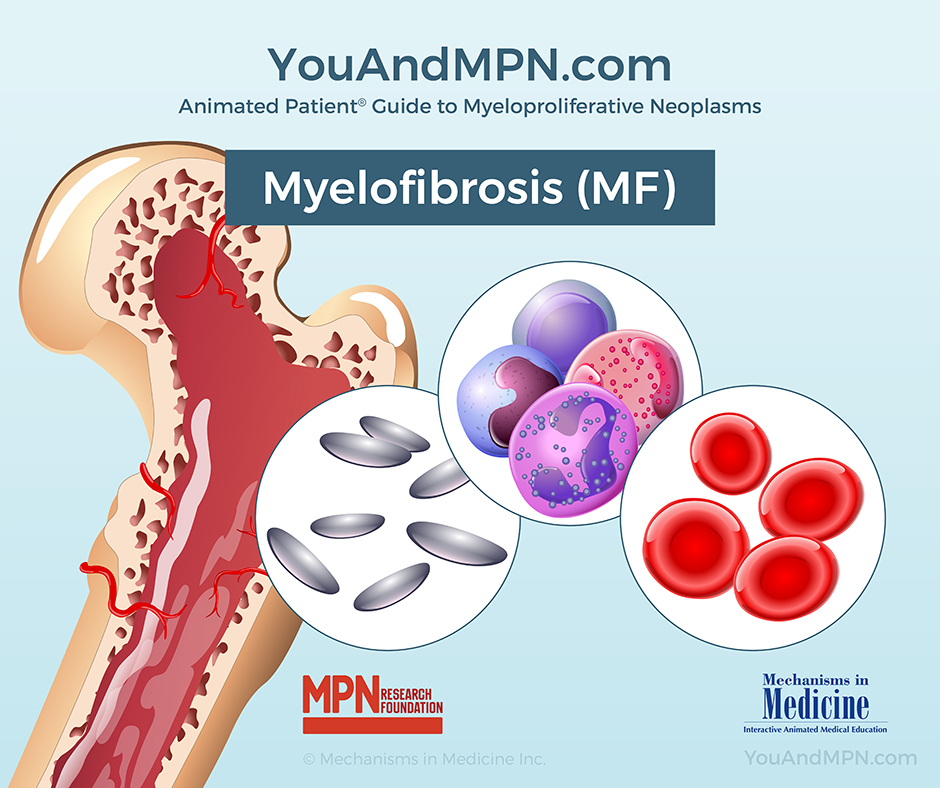 Myelofibrosis – MPN Research Foundation